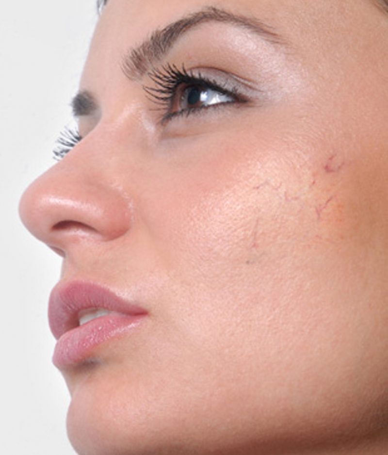 Facial Spider Veins - Broken Blood Vessels Treatment